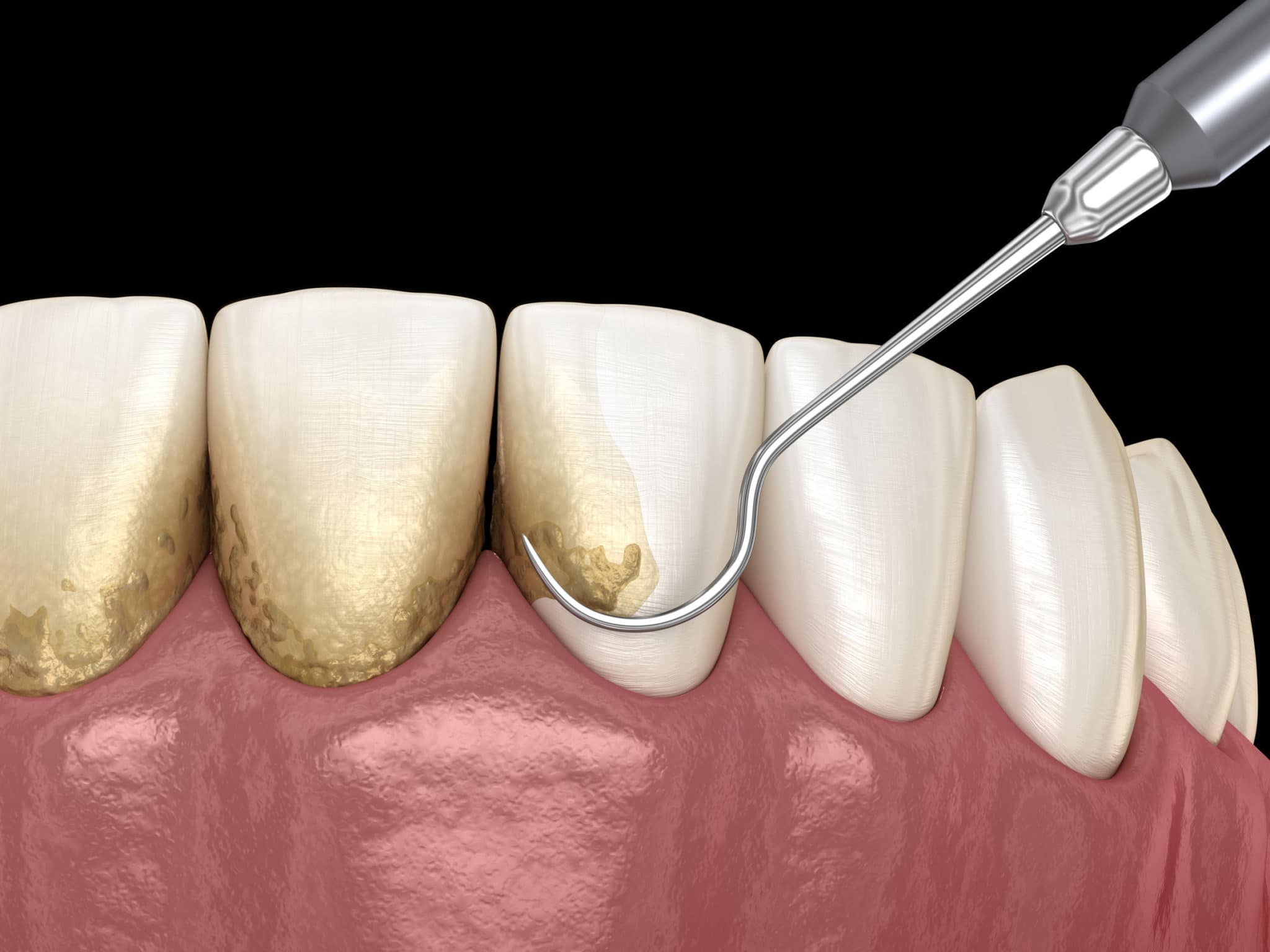 How To Remove Tartar From Teeth Without A Dentist Sarasota Dentistry