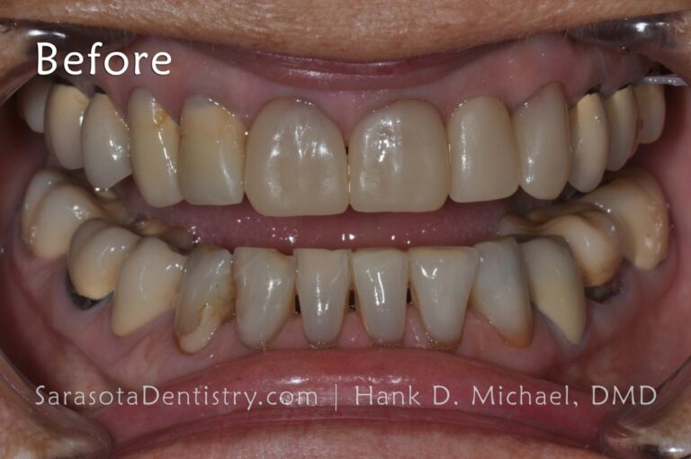 How to Fix Black Triangles in Teeth - Sarasota Dentistry