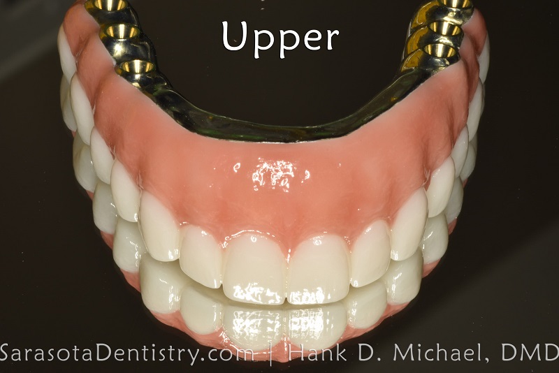 Types of Dental Implants - Sarasota Dentistry