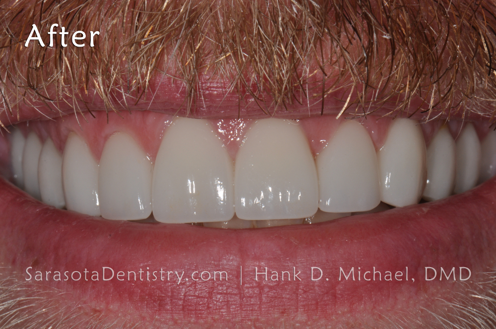 Brown Spots on Teeth: Causes, Prevention, and Removal | How to Get Rid ...