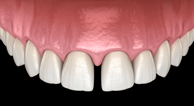 Diastema Causes and Treatment Options - Sarasota Dentistry