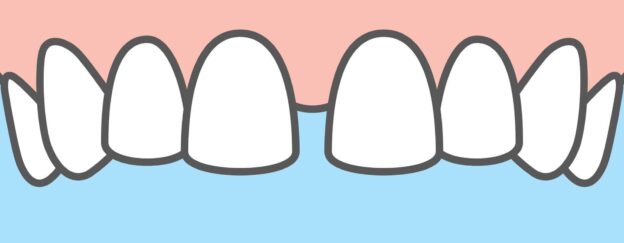 Diastema Causes and Treatment Options - Sarasota Dentistry