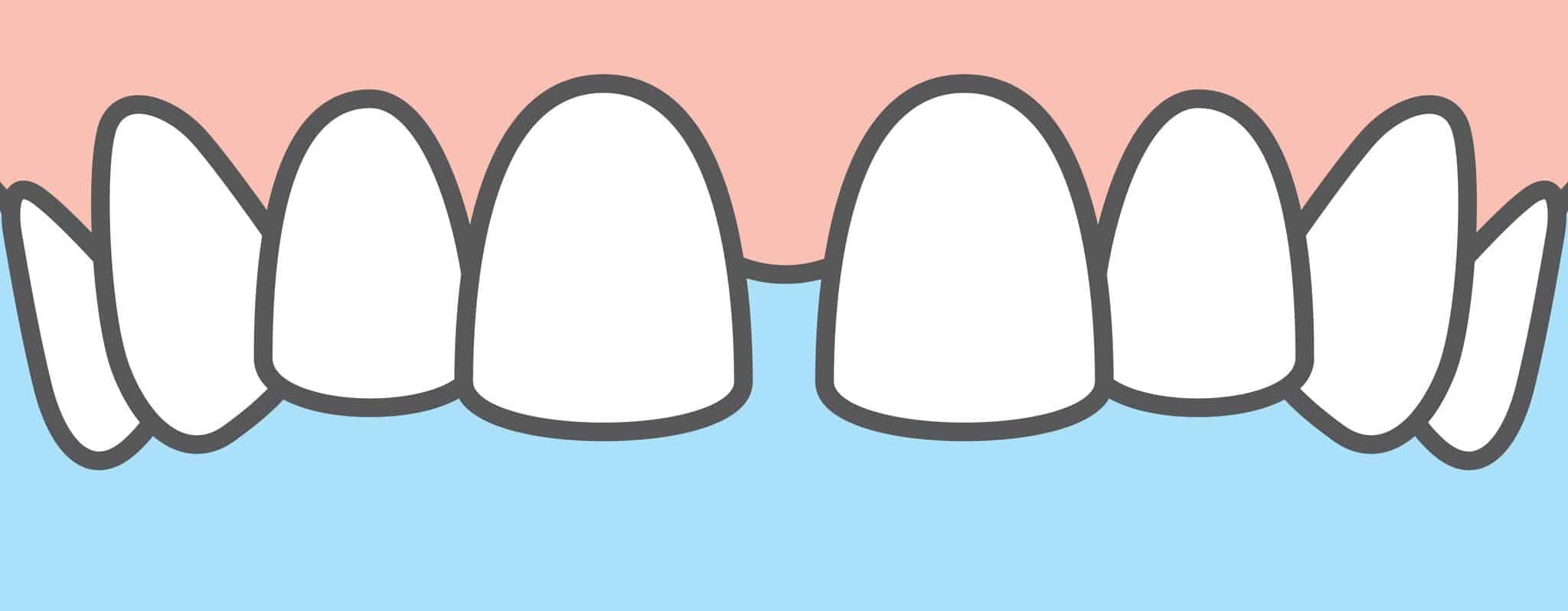 Diastema Causes and Treatment Options - Sarasota Dentistry