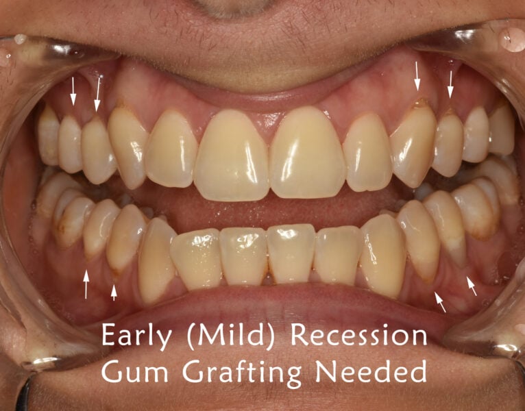 Receding Gums Stages Sarasota Dentistry