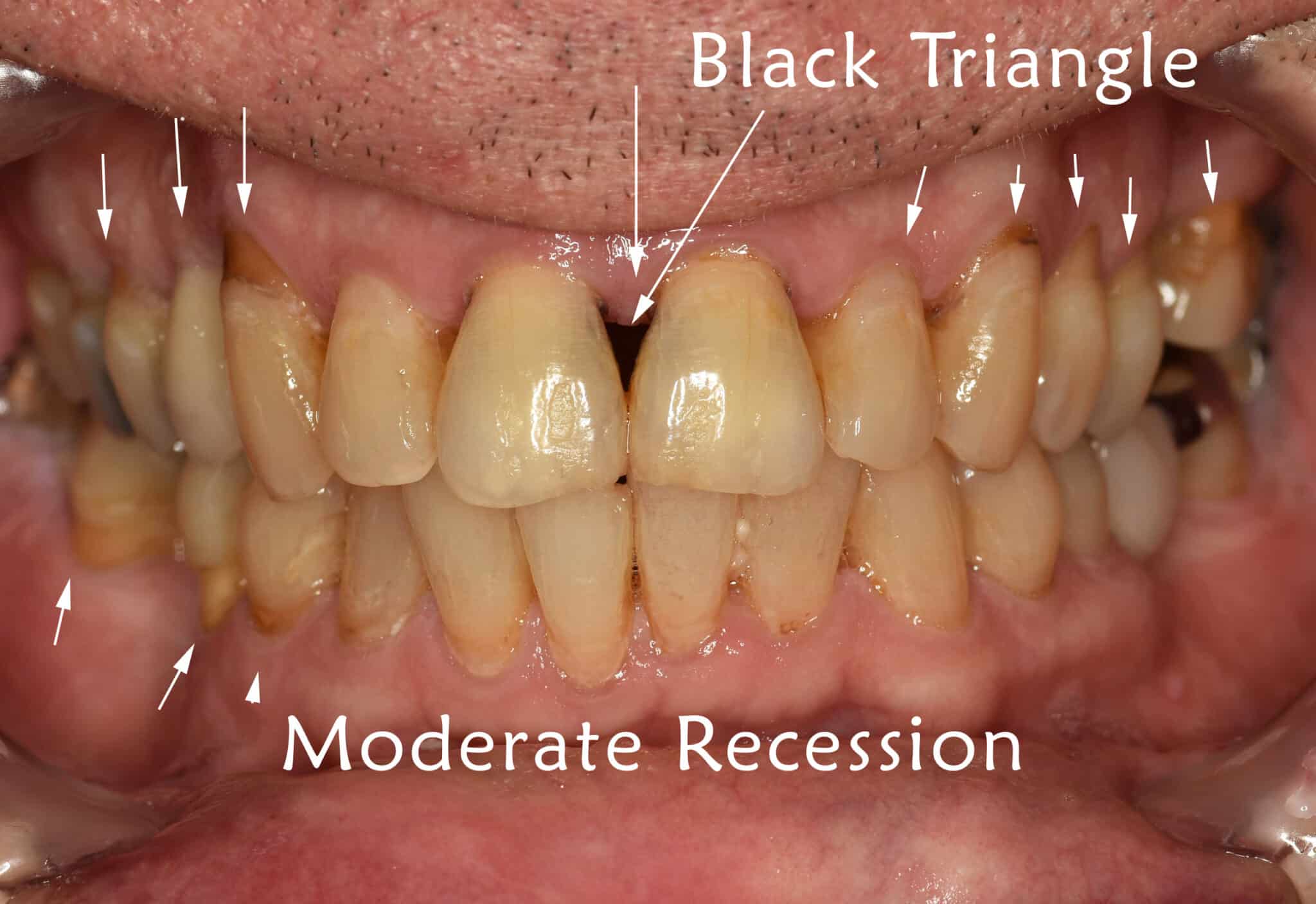 Receding Gums Stages - Sarasota Dentistry